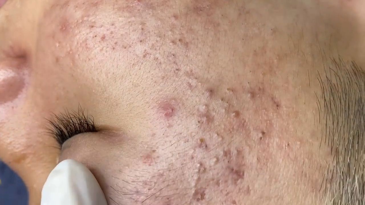 272 • Acne collection • АСМР • Relax Spa