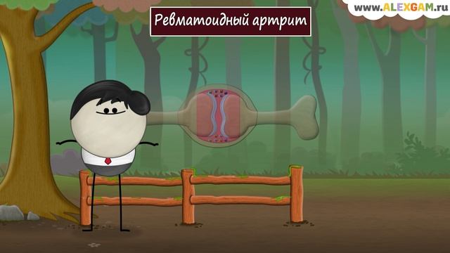 Что такое артрит?