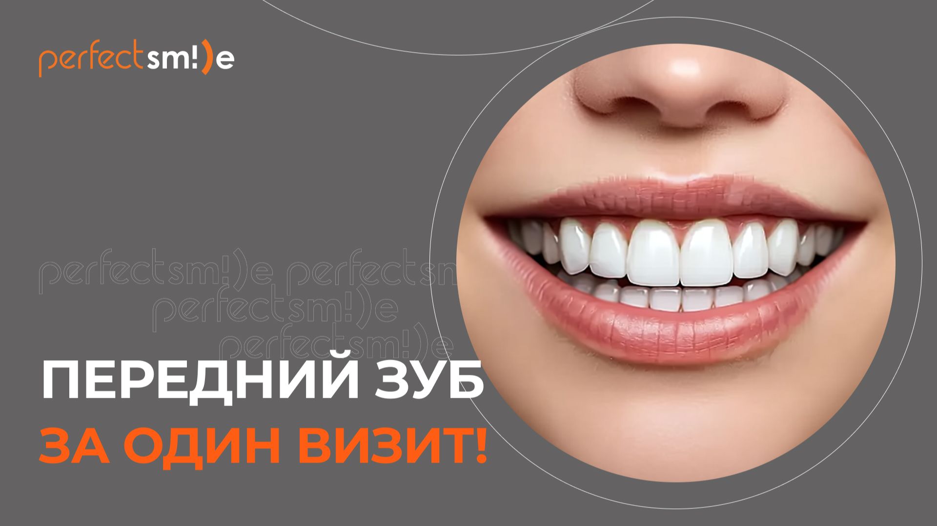 🦷 Передний зуб за ОДИН визит! Эстетическая имплантация в PerfectSmile ✨