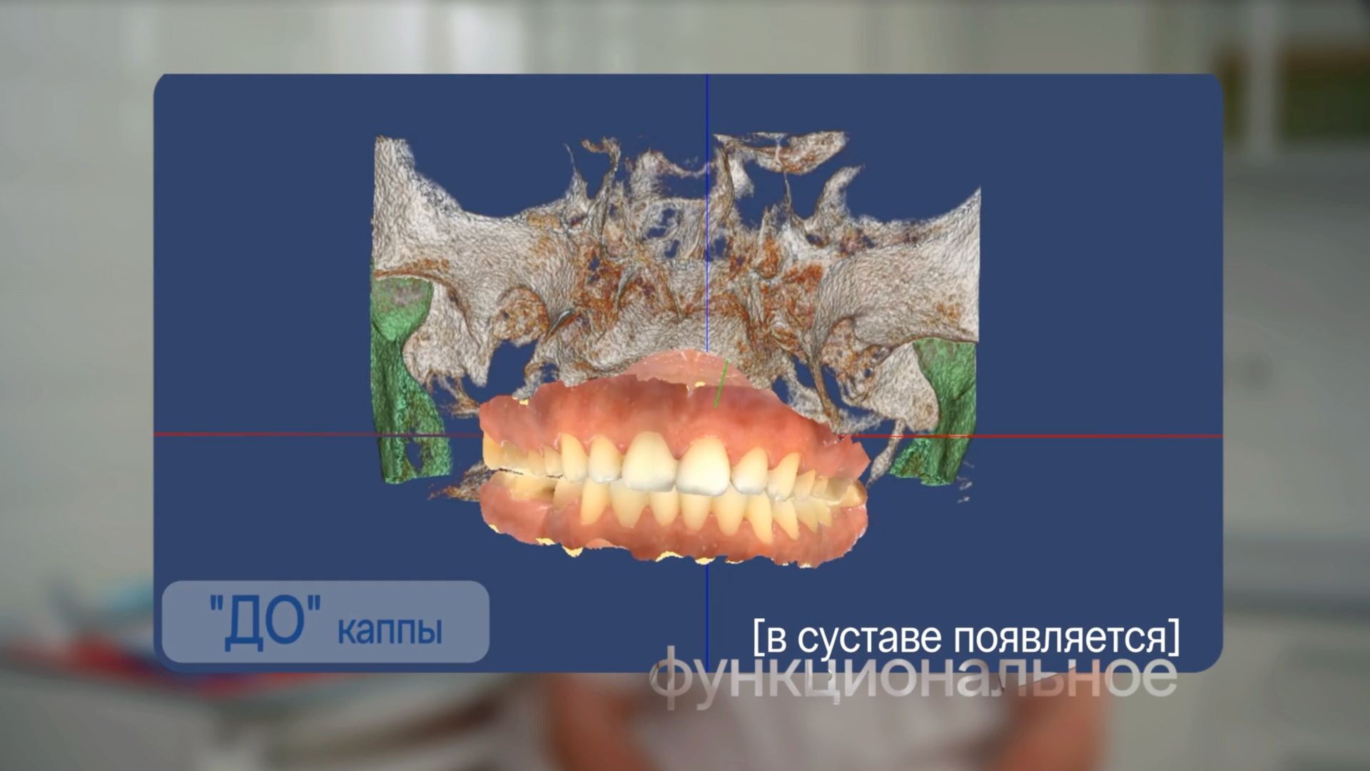 Зачем нужны виниры после гнатолога, если уже ничего не болит?
