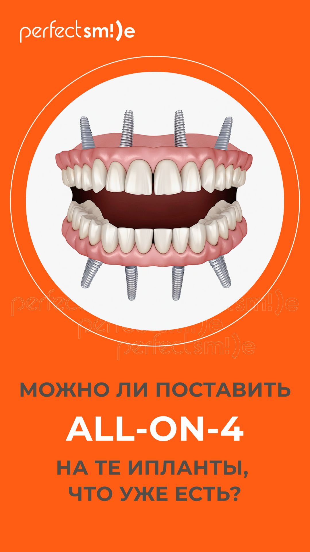 🧐 All-on-4 на установленных имплантах: реально ли это?