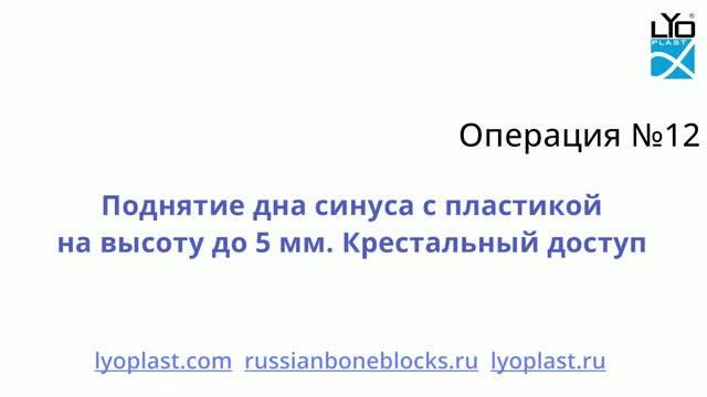 Операция №12 Поднятие дна синуса с пластикой на высоте до 5мм. Крестальный доступ