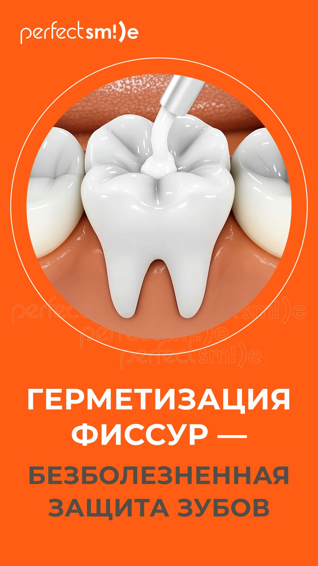 Герметизация фиссур — безболезненная защита зубов ✨