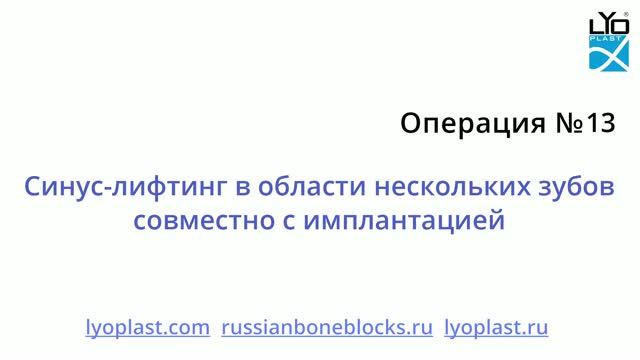 Операция №13 Синус-лифтинг в области нескольких зубов совместно с имплантацией