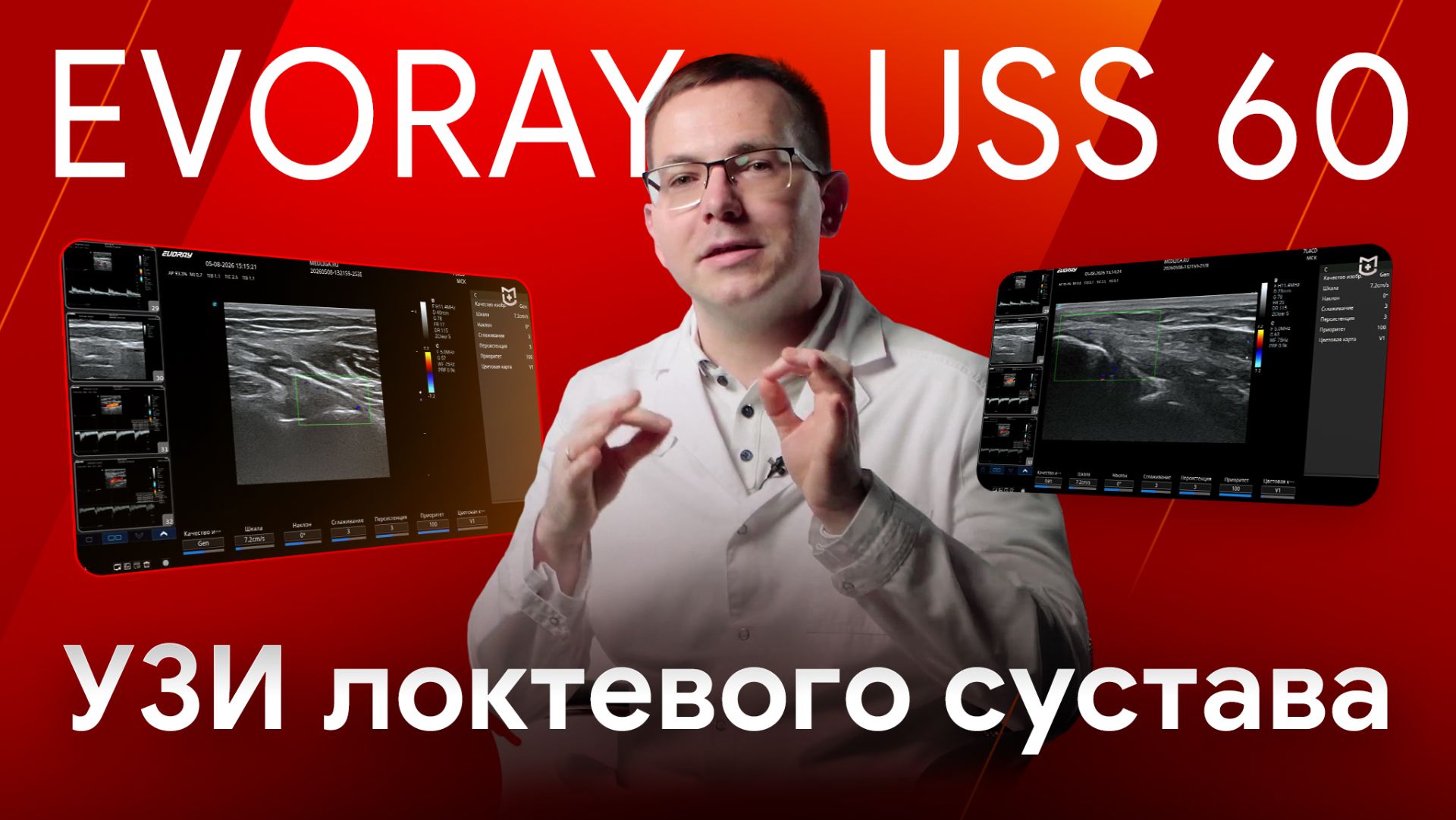 УЗИ локтевого сустава на EVORAY USS 60: разбор структур сустава