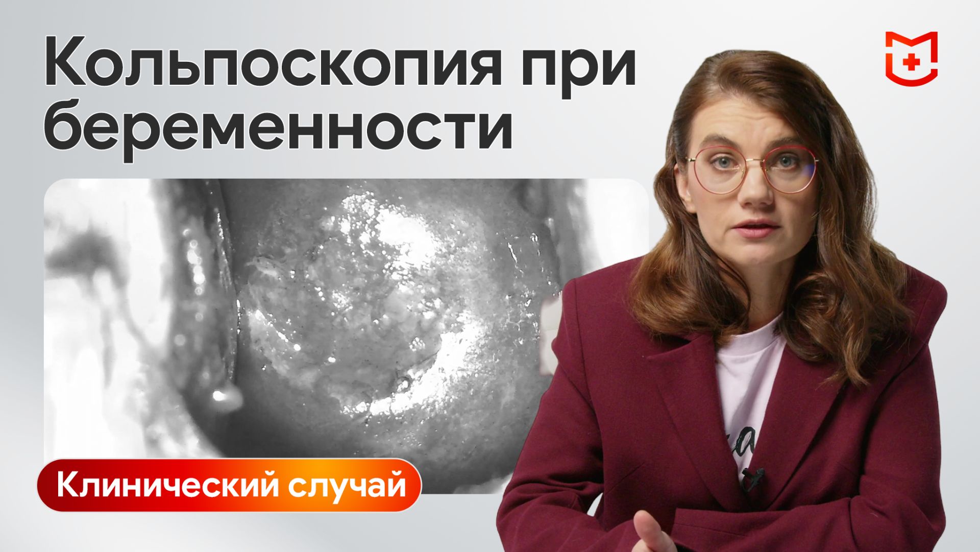 Кольпоскопия и работа программы «Кольпоэксперт»