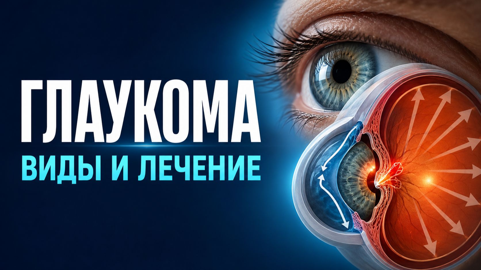 Глаукома
