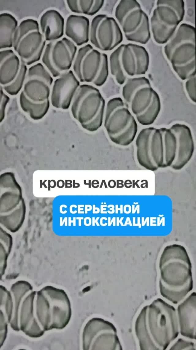 Кровь человека с высокой интоксикацией
