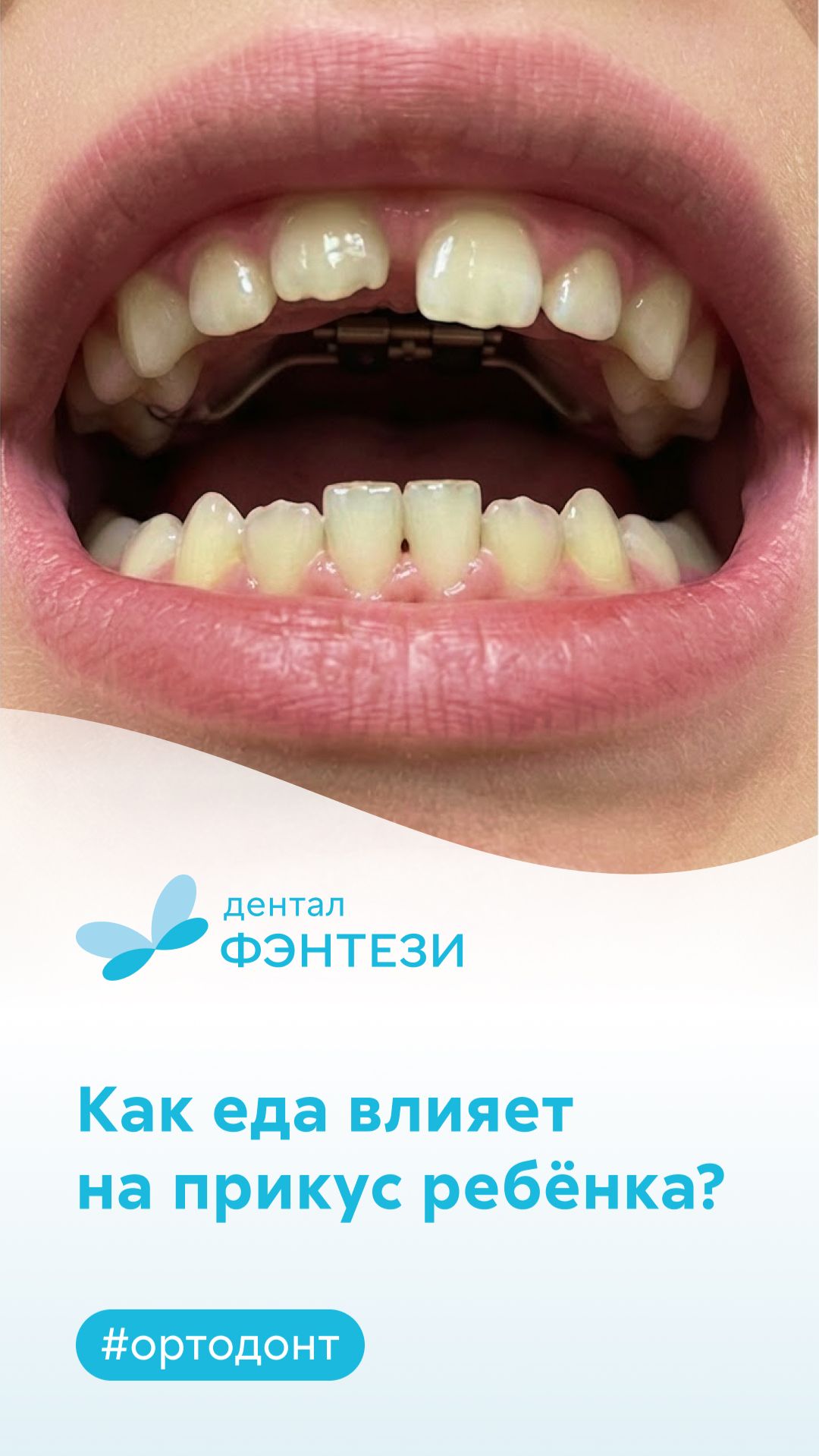 Ортодонтия для детей в Дентал Фэнтези: ровные зубы, правильный прикус