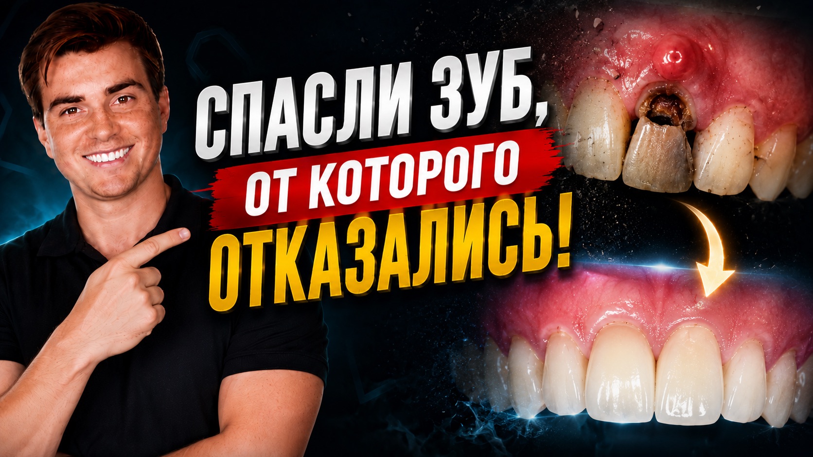 Киста в зубе? Не удаляй!