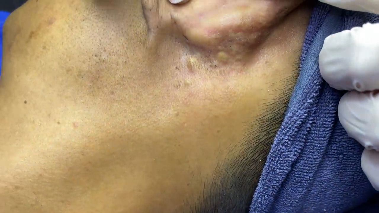 Relax Spa • Acne collection