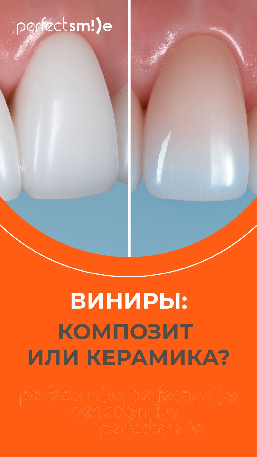 Виниры