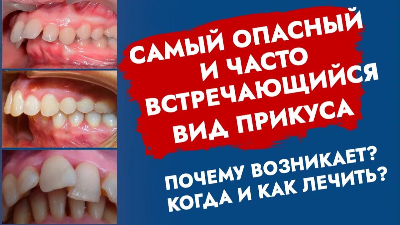 Ортодонтия. Исправление прикуса.