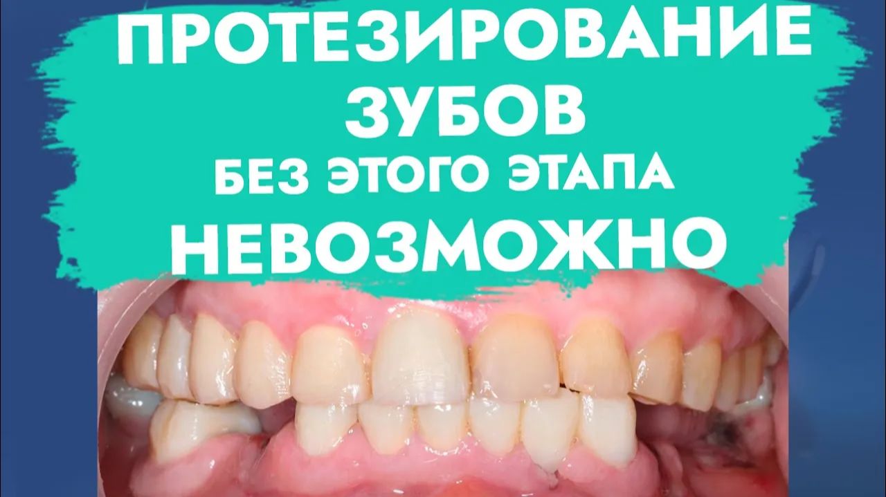 Стоматолог-ортопед. Несъёмные протезы.
