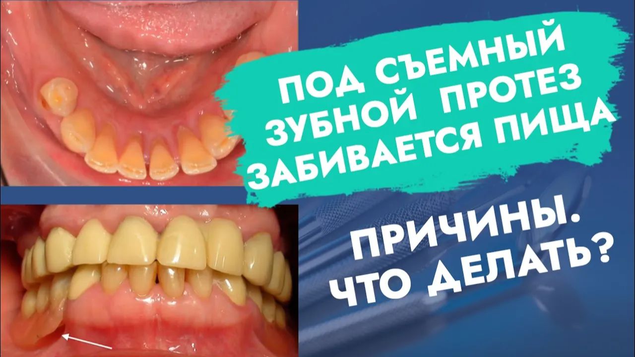 Стоматолог-ортопед. Съёмные протезы.