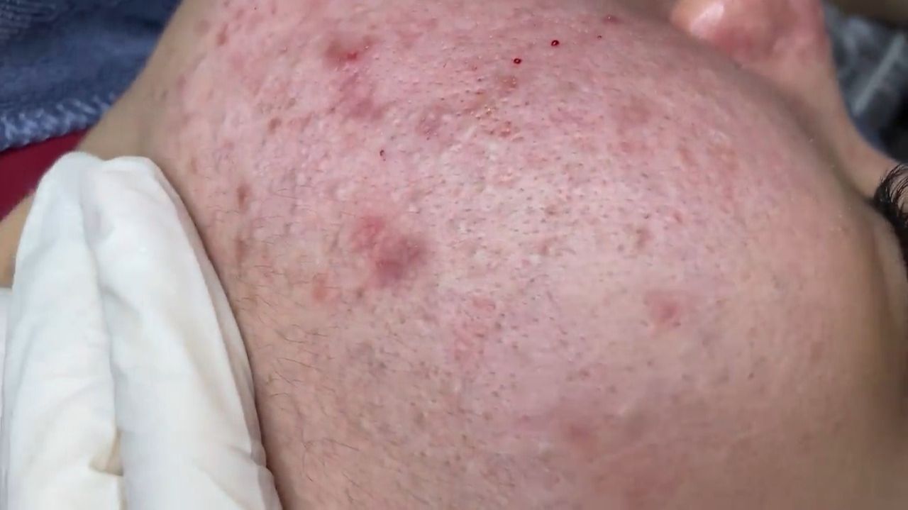 Relax Spa • Acne collection