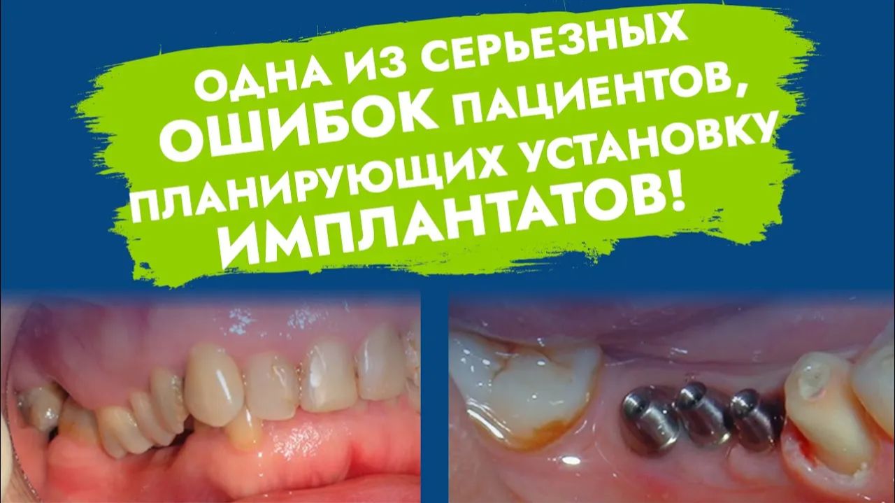 Имплантация зубов