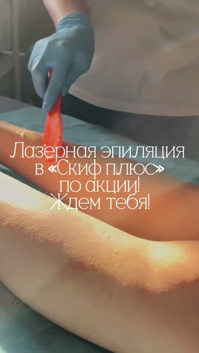 Лазерная эпиляция