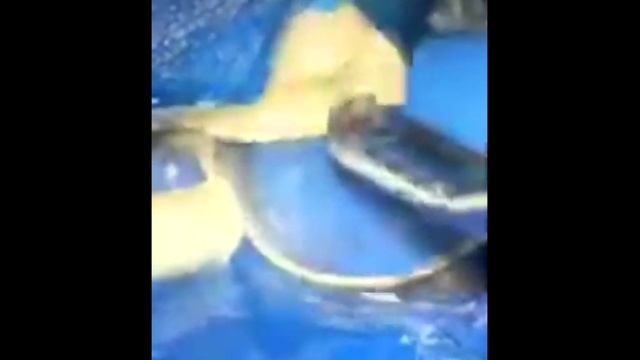 2020_05_14_Никаких рентгенологических предпосылок не было. Оказалась трещина дистально.