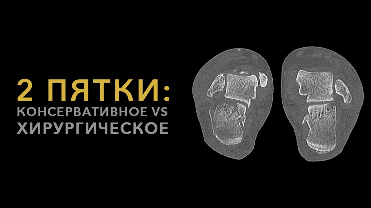 2 пятки: консервативное vs хирургическое