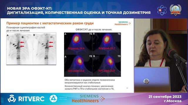 Внедрение количественного анализа ОФЭКТ-изображений в клиническую практику
