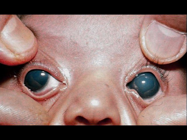 Проверка зрения новорожденного, Глаукома, Причины, Лечение © Newborn's eyesight check, Glaucoma