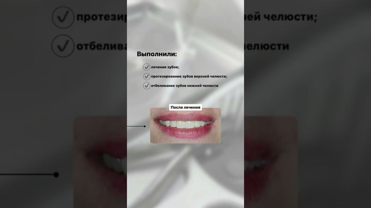 Кейс лечение зубов, отбеливание и протезирование #shots  #отбеливаниезубов  #протезированиезубов