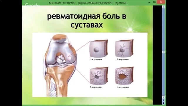 Боль в суставах. Елена Бахтина, врач-гинеколог, генетик, нутрициолог.