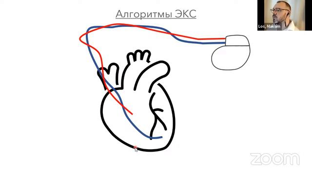 Интерпретация ЭКГ у пациентов со стимуляторами. ЭКГ картина современных алгоритмов кардиостимулятора