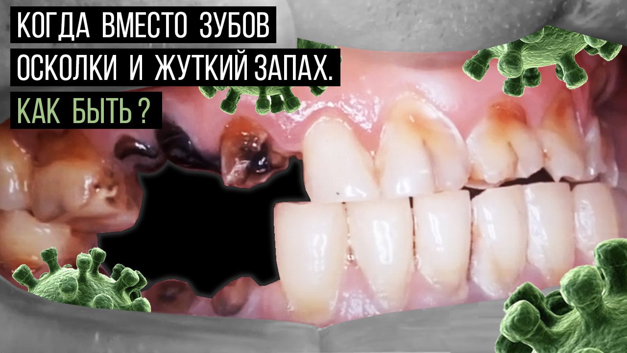 [Случай совершенно не сложный?] Просто нужно восстановить зубы обеих челюстей в 60 лет‼️