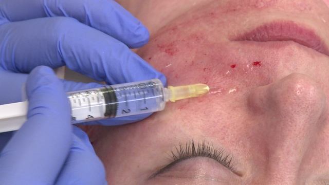 теория уколов