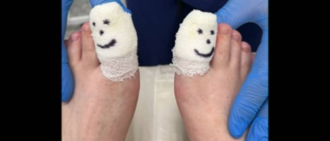 ✅ Перевязка после краевой резекции вросшего ногтя на больших пальцах обеих стоп