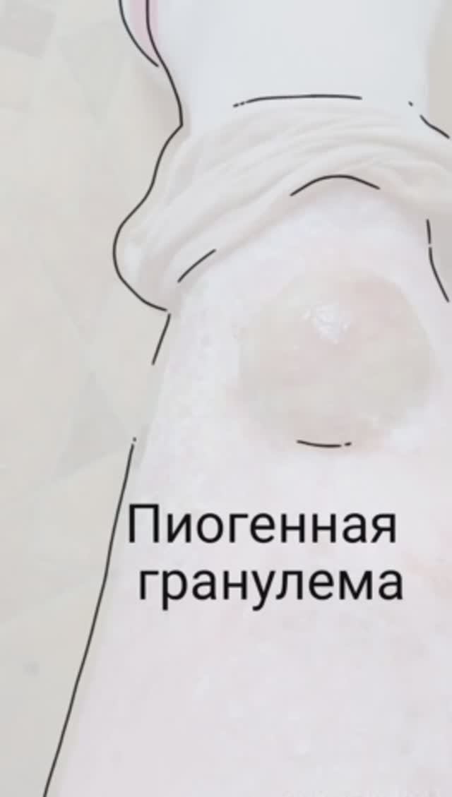 Пиогенная гранулема