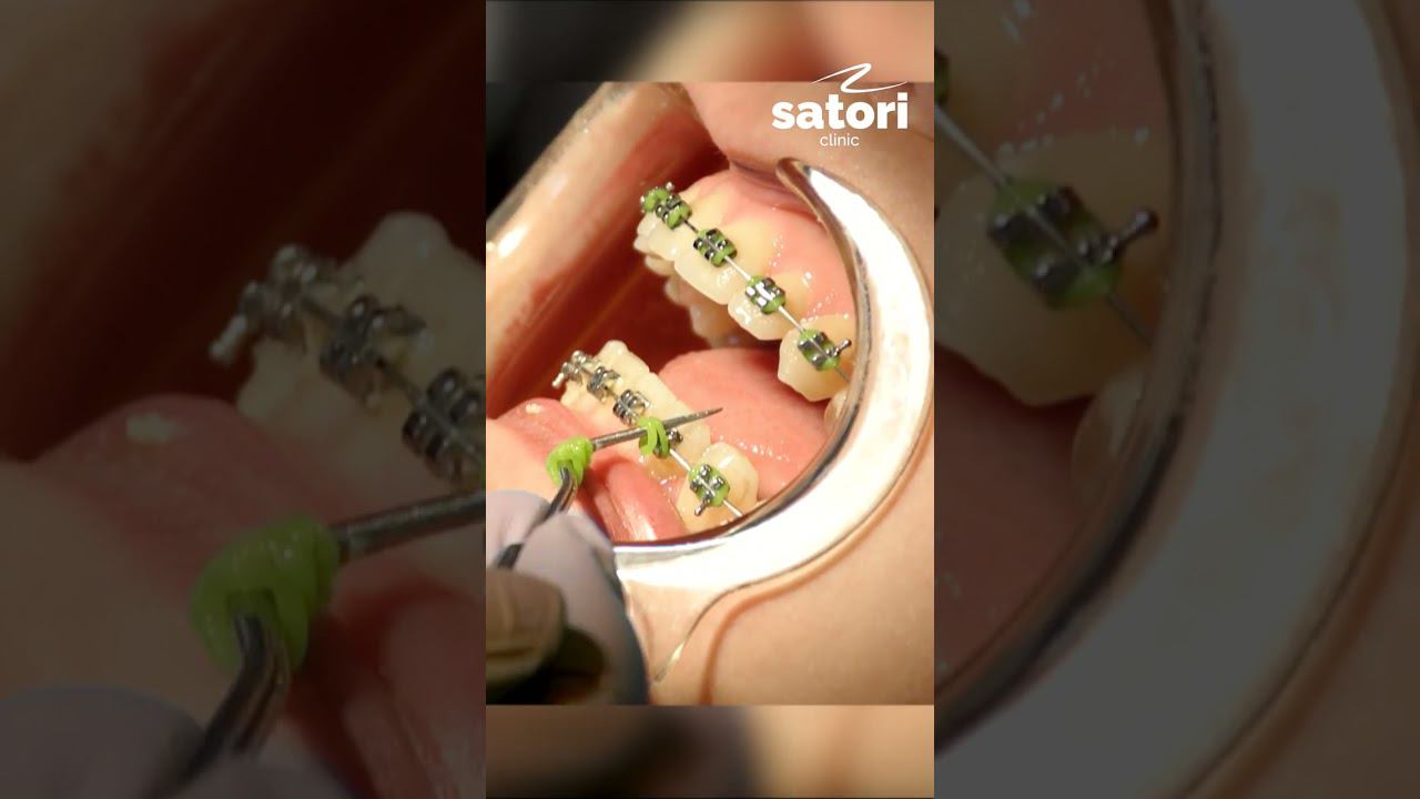 Снятие колечек на лигатурных брекетах #зубы #брекеты #braces