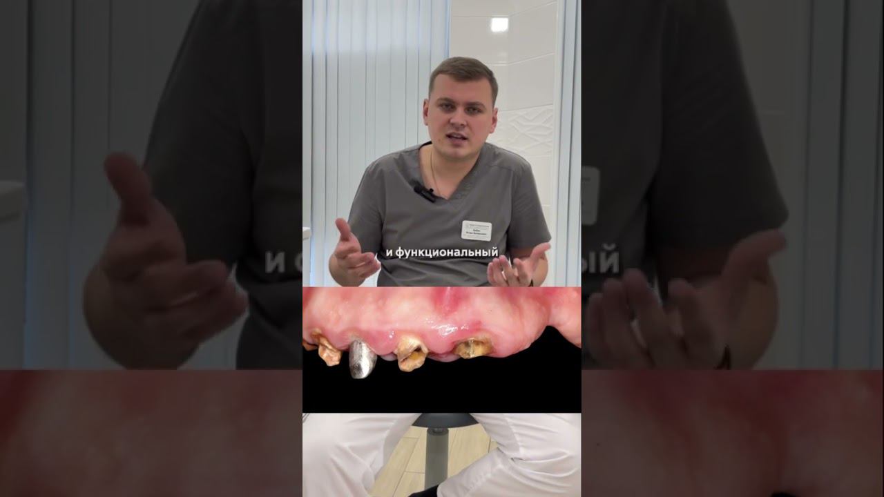 Зубы за один день по методике «Все на 4»