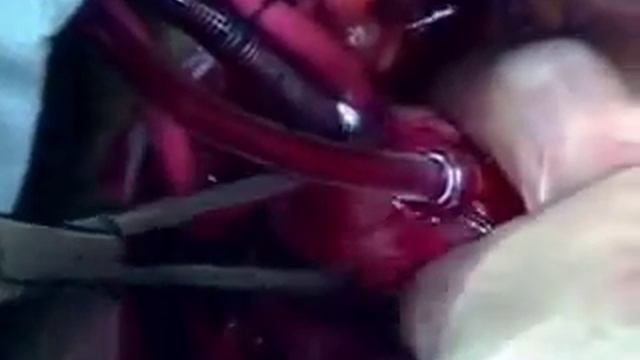 Coronary Bypass Surgery