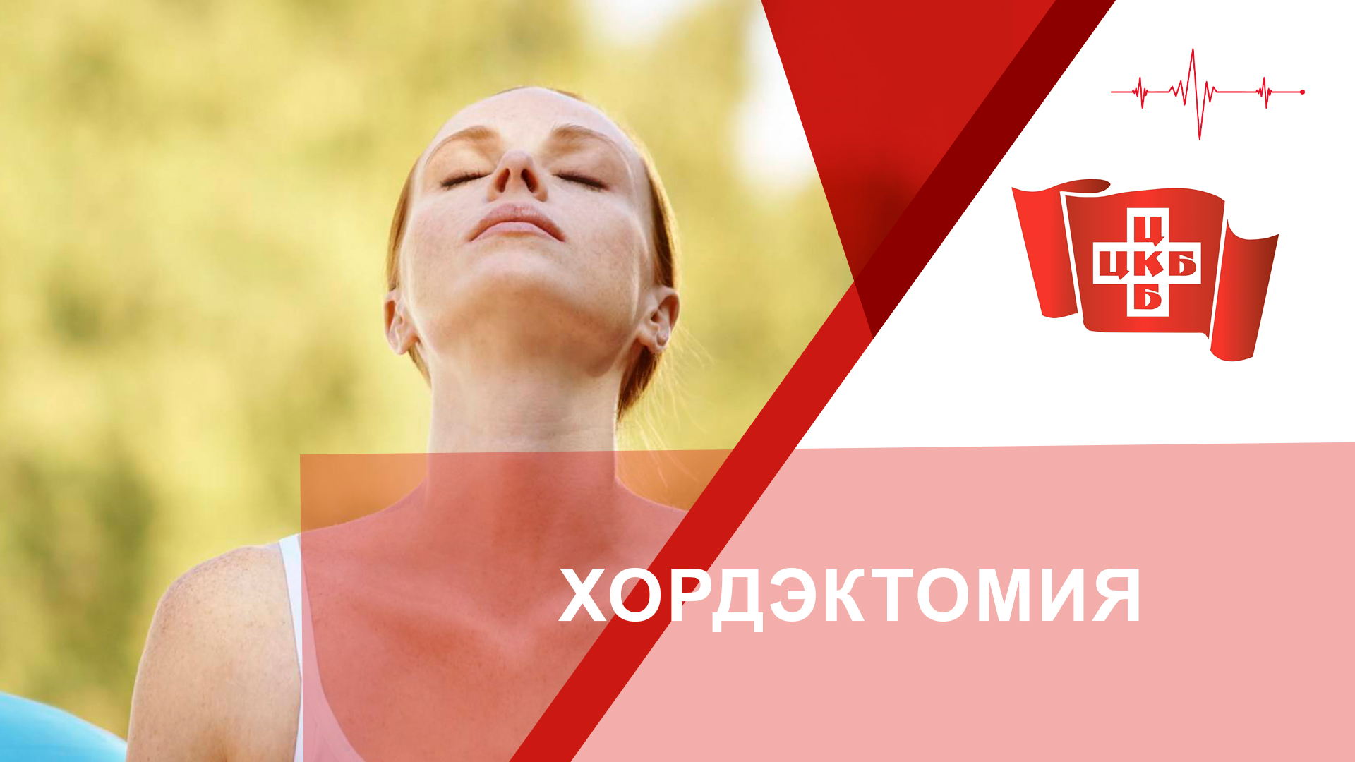 Хордэктомия