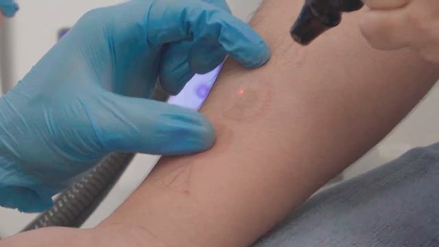 УДАЛЕНИЕ ПИГМЕНТОВ БРОВИ. ЧАСТЬ 4