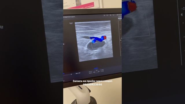 Нетипичная форма вены на ноге. Узи сосудов. Флеболог. Флеболог Москва