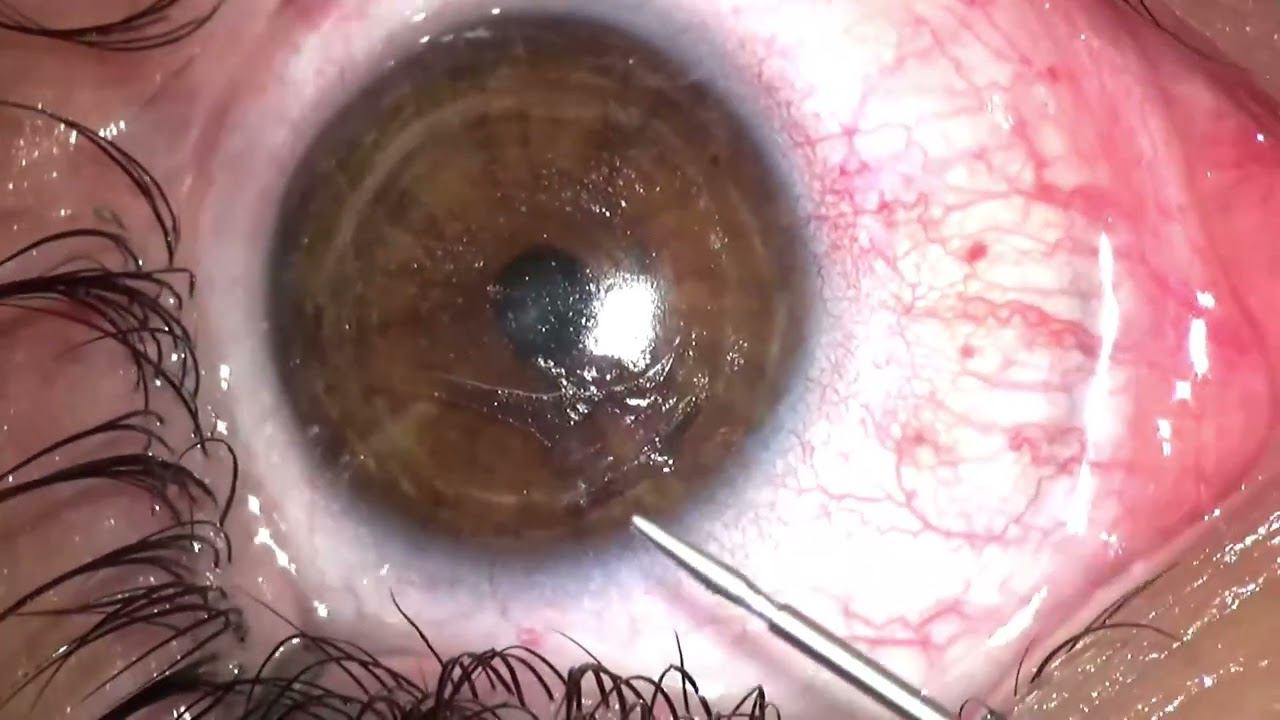 Международная конференция по офтальмологии "ВОСТОК-ЗАПАД 2023", Зал "Нарыстау", день 2