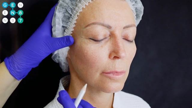 НИТЕВОЙ (ТРЕДЛИФТИНГ) ДЛЯ ПОДТЯЖКИ ОВАЛА ЛИЦА Сеть клиник инновационной косметологии GEN87(1)