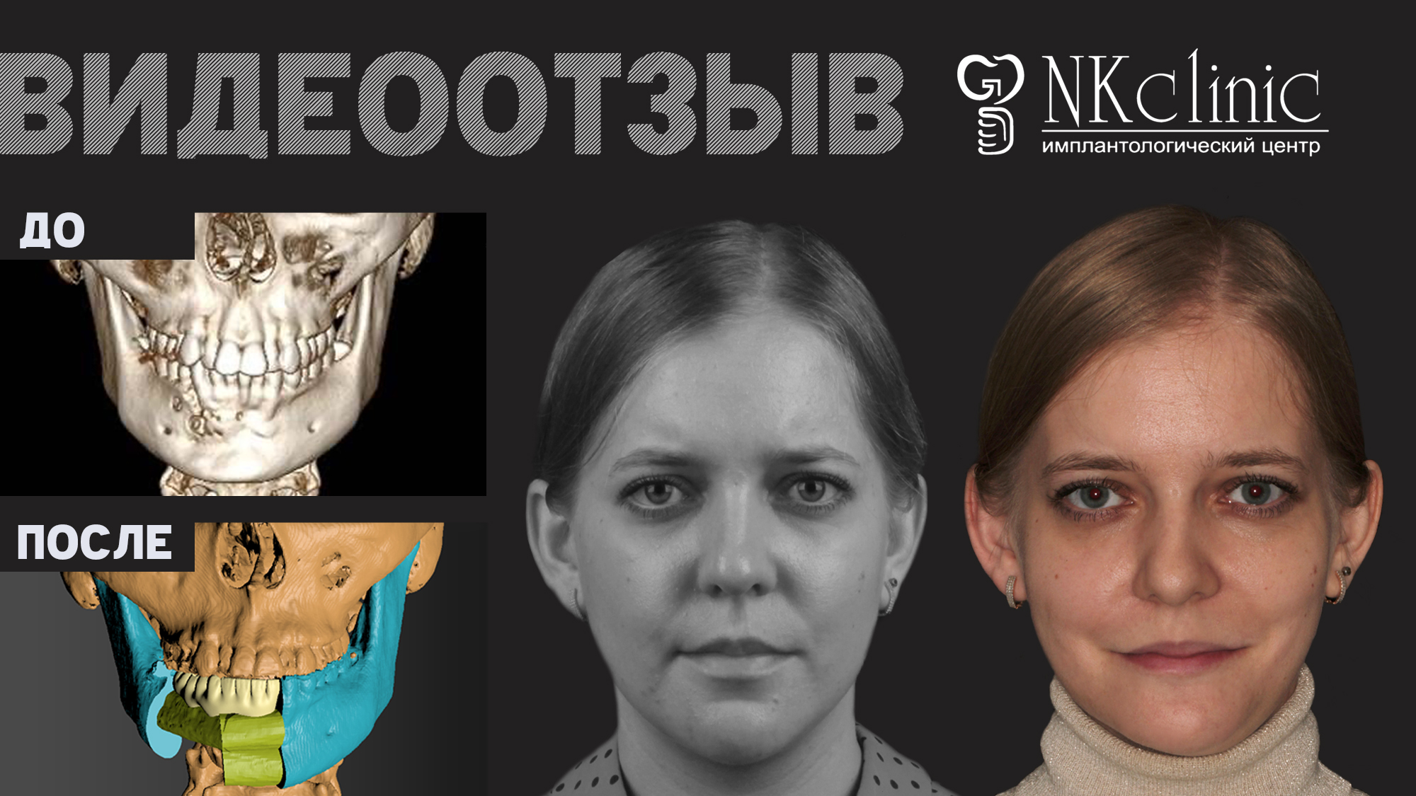 Удаление опухоли (амелобластомы) нижней челюсти. Видеоотзыв пациентки