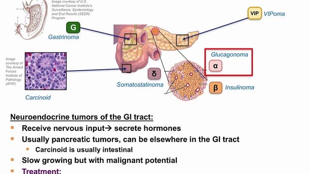 USMLE RX - 3.Эндокринная система - 3.Патология - 11.Глюкагонома