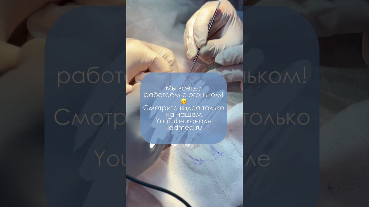 УРОЛОГИЯ. ТИЗЕР "Обрезание радиоволновым скальпелем БЕЗ ОЖОГОВ" #обрезание #shorts #уролог