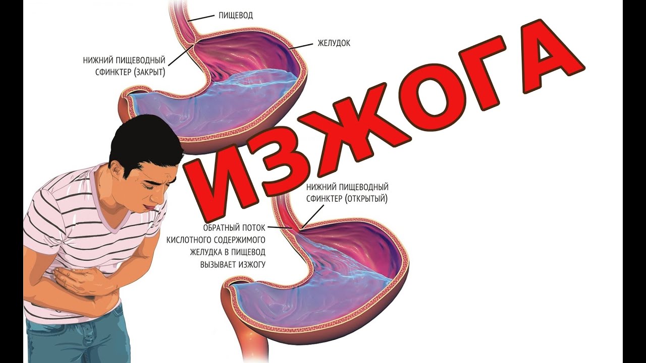 ✔️ Изжога как лечить в домашних условиях. Инфо-таблетка от изжоги.