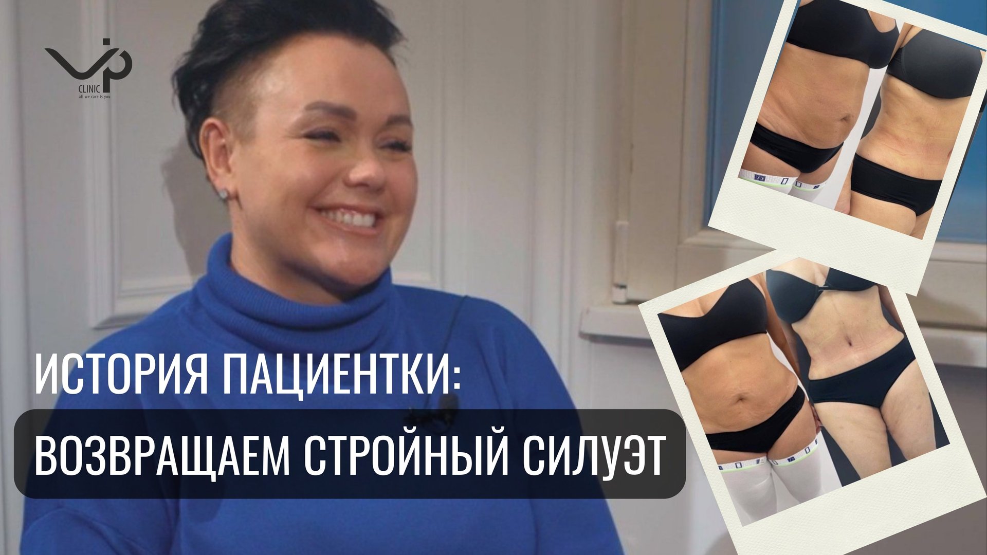 Выпуск 2. "Преображение с VIP Clinic".  История пациента по Абдоминопластике.