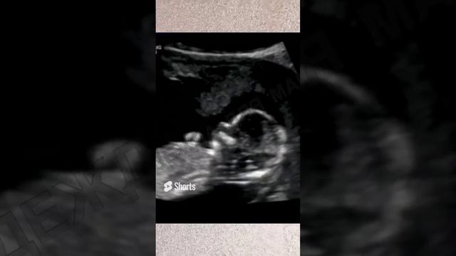 Все 3 скрининга, в видео на канале?