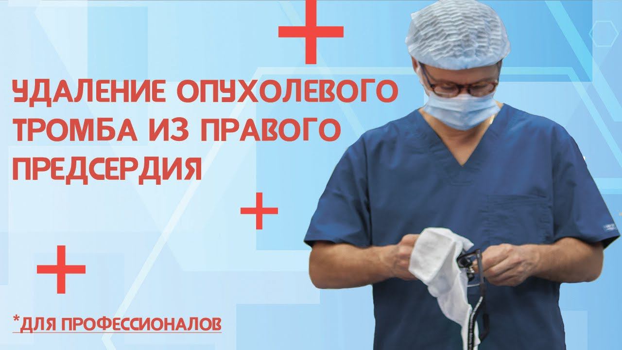 Гемигепатэктомия с тромбэктомией из правых отделов сердца в условиях ИК (для профессионалов)