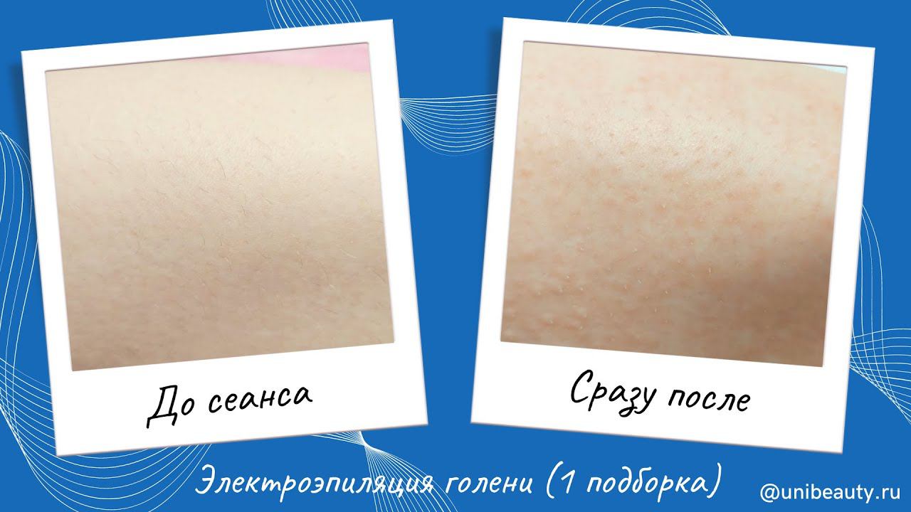 Электроэпиляция ног методом blend