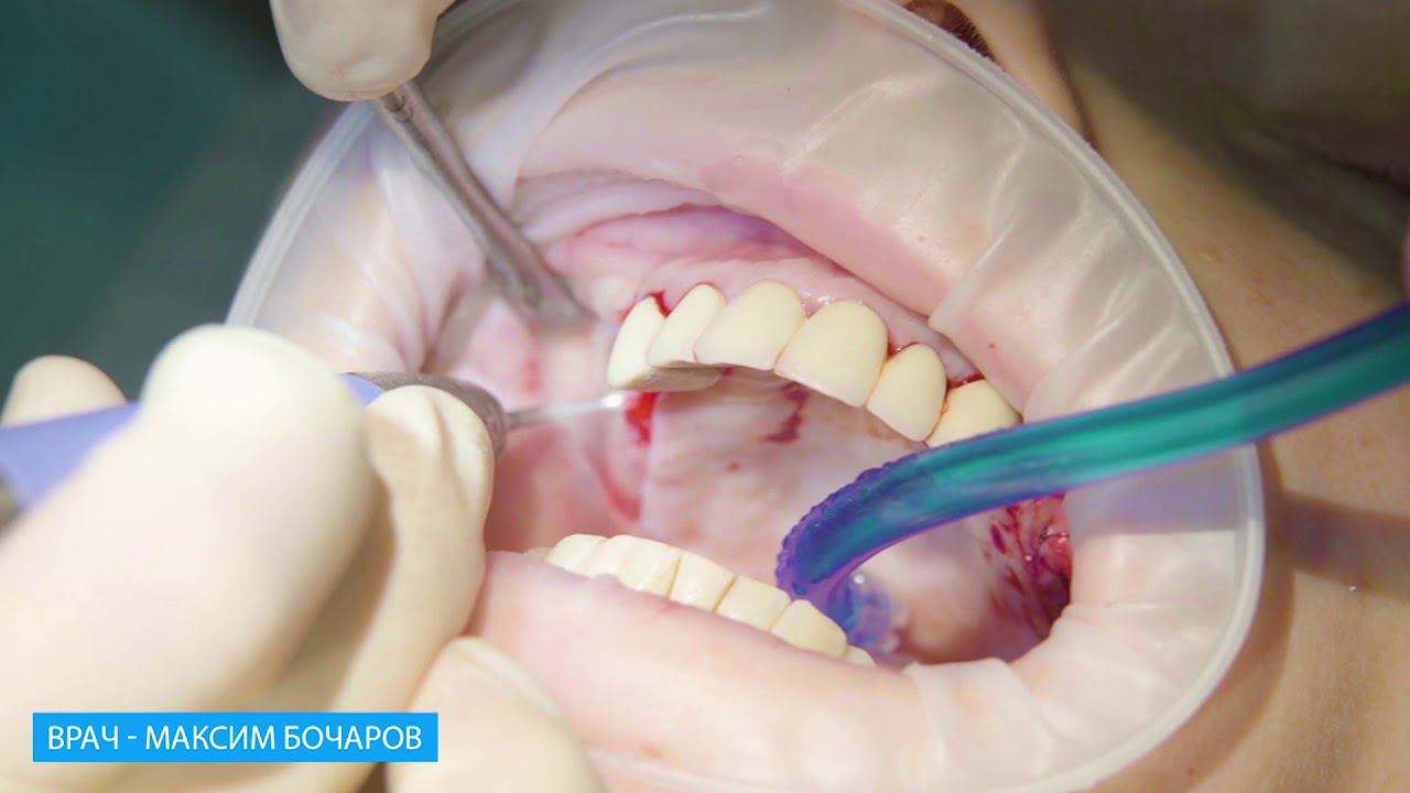 DENTIS. Выполнение процедуры двустороннего синус-лифтинга.